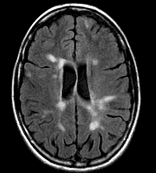 À quoi sert l'IRM dans la sclérose en plaques